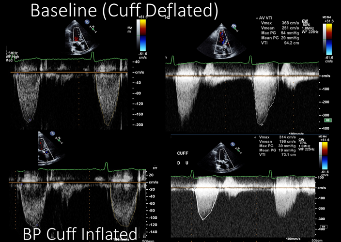Case 8 post-teaching | Aortic Stenosis Quality Control Study